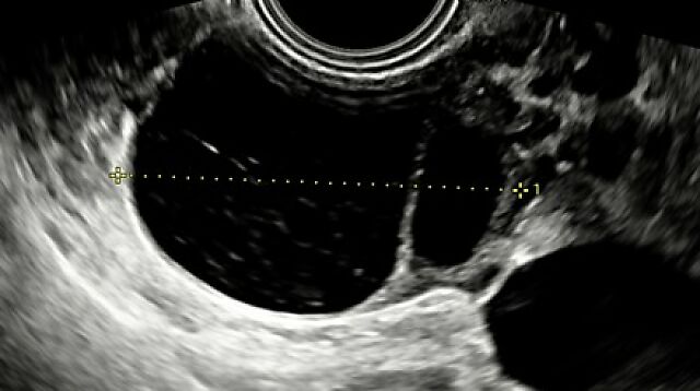 Ultrasound Diagnosis and Management of Trophoblastic Disease | Article ...